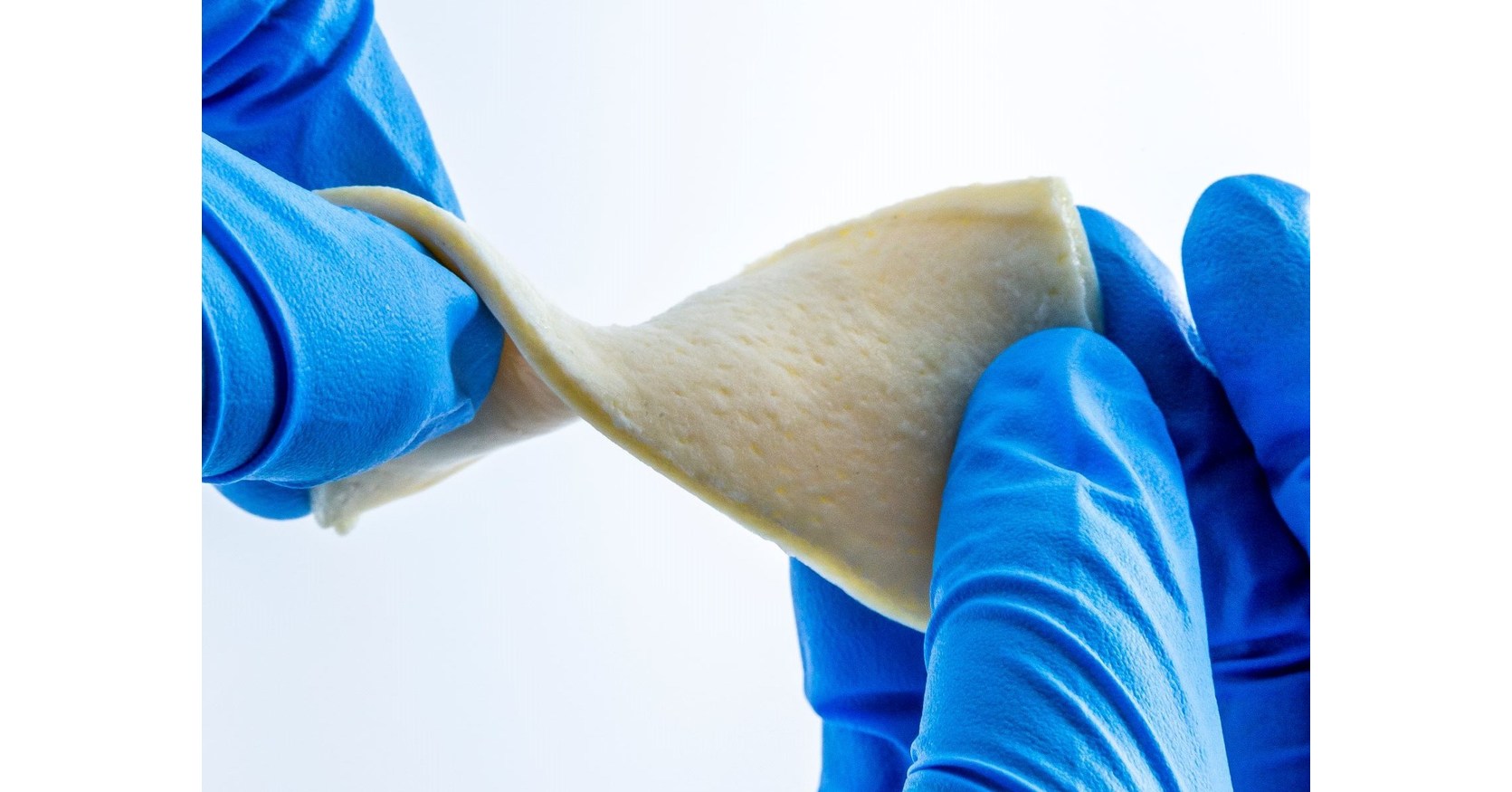 AlloSource Launches AlloMend Ultra-Thick Acellular Dermal Matrix