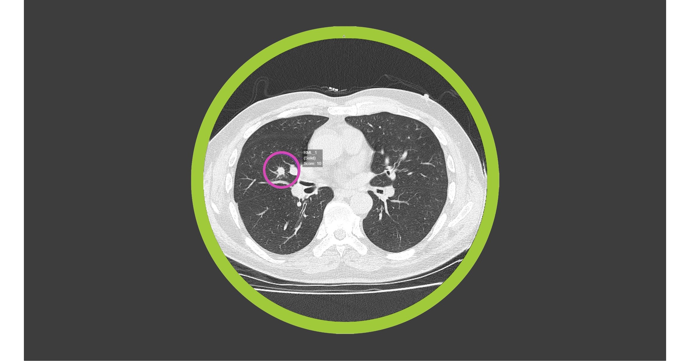 Optellum Announces Strategic Collaboration With The Lung Cancer ...