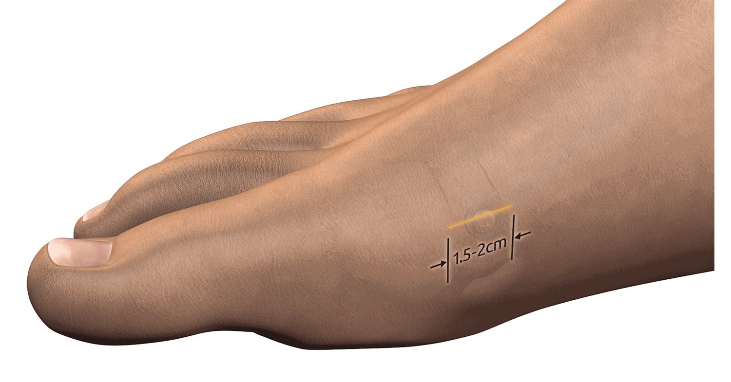 Bunion Patients Have a Walking Recovery and an Invisible Incision With ...
