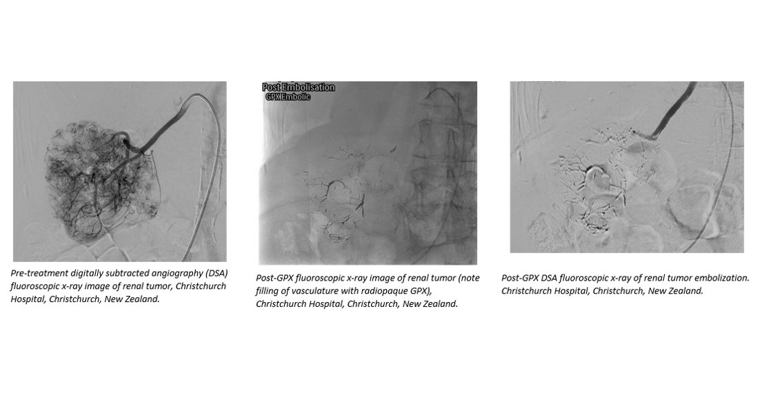 Innovative Embolic Device for Treating Tumors Highlighted in "BEST of ...