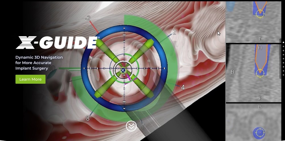 X-Nav Technologies Announces 150,000+ Dental Implants Navigated Using ...