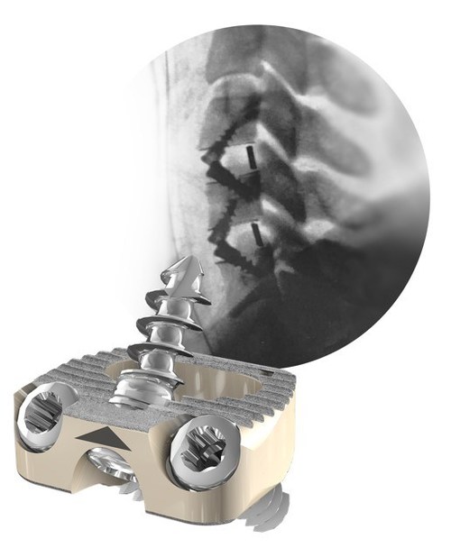 New Publication Supports Clinical Effectiveness of Centinel Spine's ...