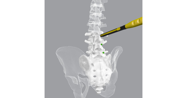 CoreLink Announces Commercial Launch Of CentraFix™ Midline Fixation System