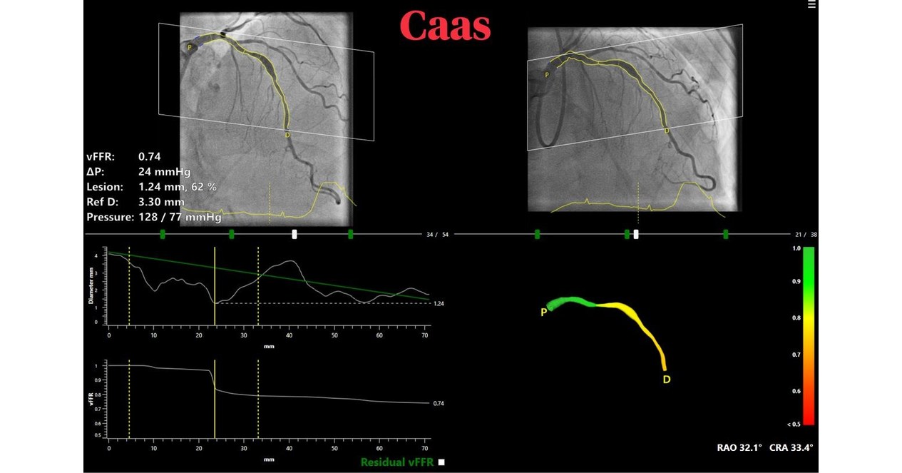 The innovative software "CAAS vFFR" by Pie Medical Imaging for the non ...