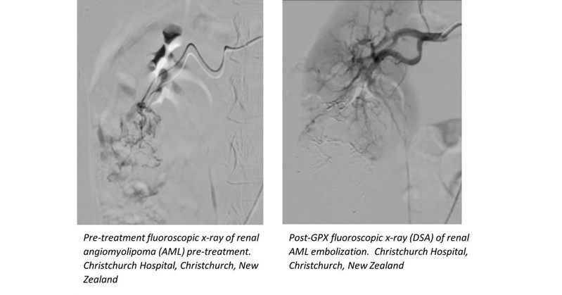 GPX Embolic Device Success in Challenging Tumor Case
