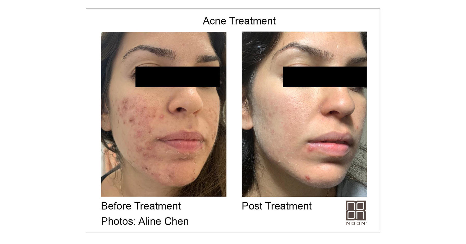 NOON Aesthetics Establishes US Sales Operation and Launches New ...
