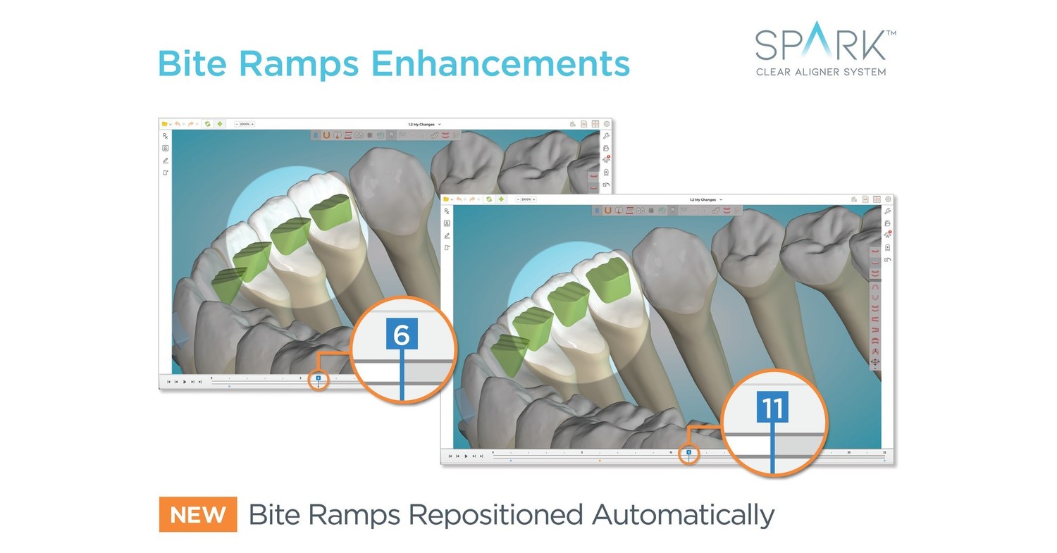 SPARK™ CLEAR ALIGNERS NEW RELEASE 12 GIVES DOCTORS MORE CONTROL ...