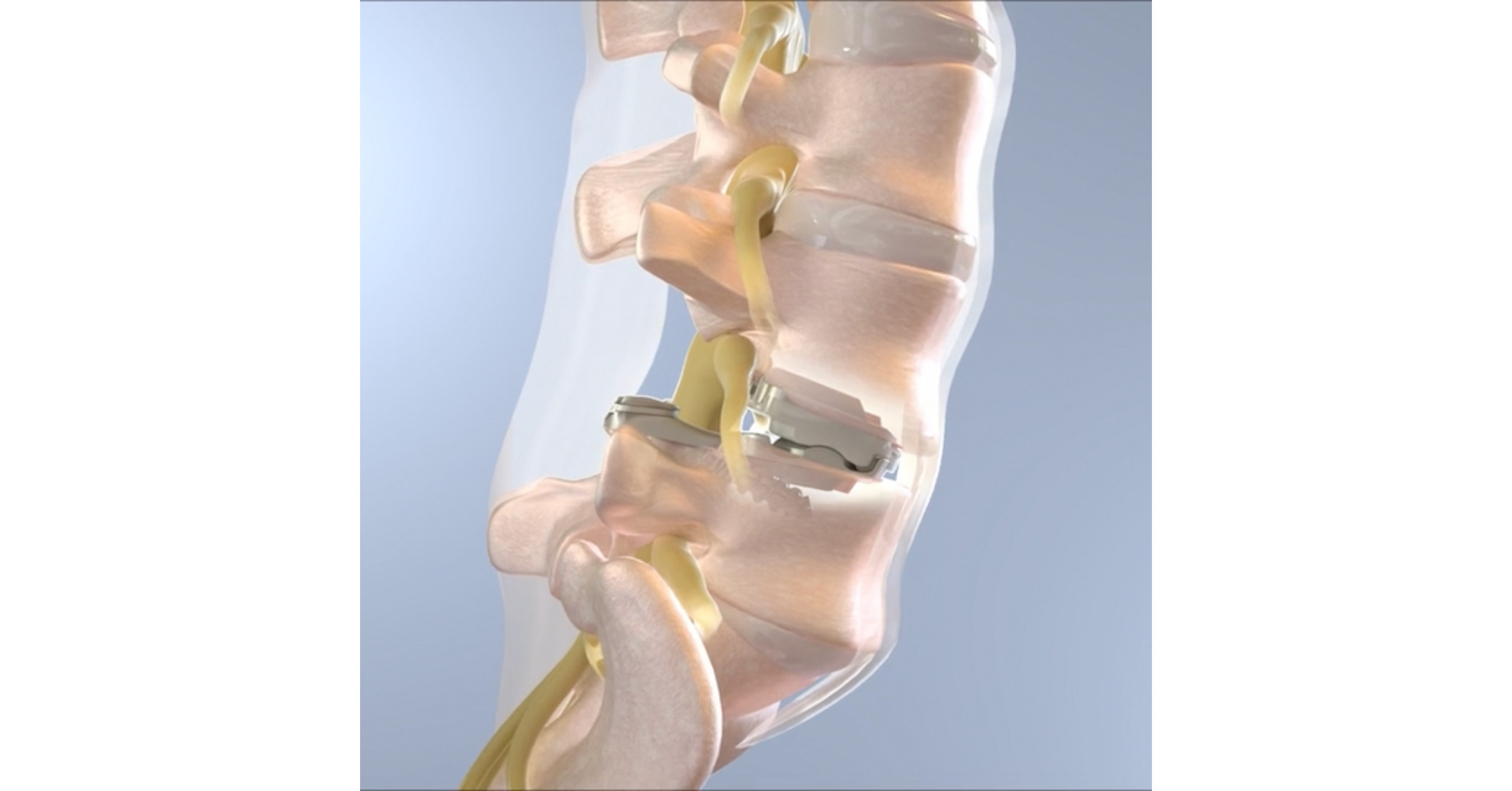 3Spine, Inc. Raises $33M in Private Series C Round