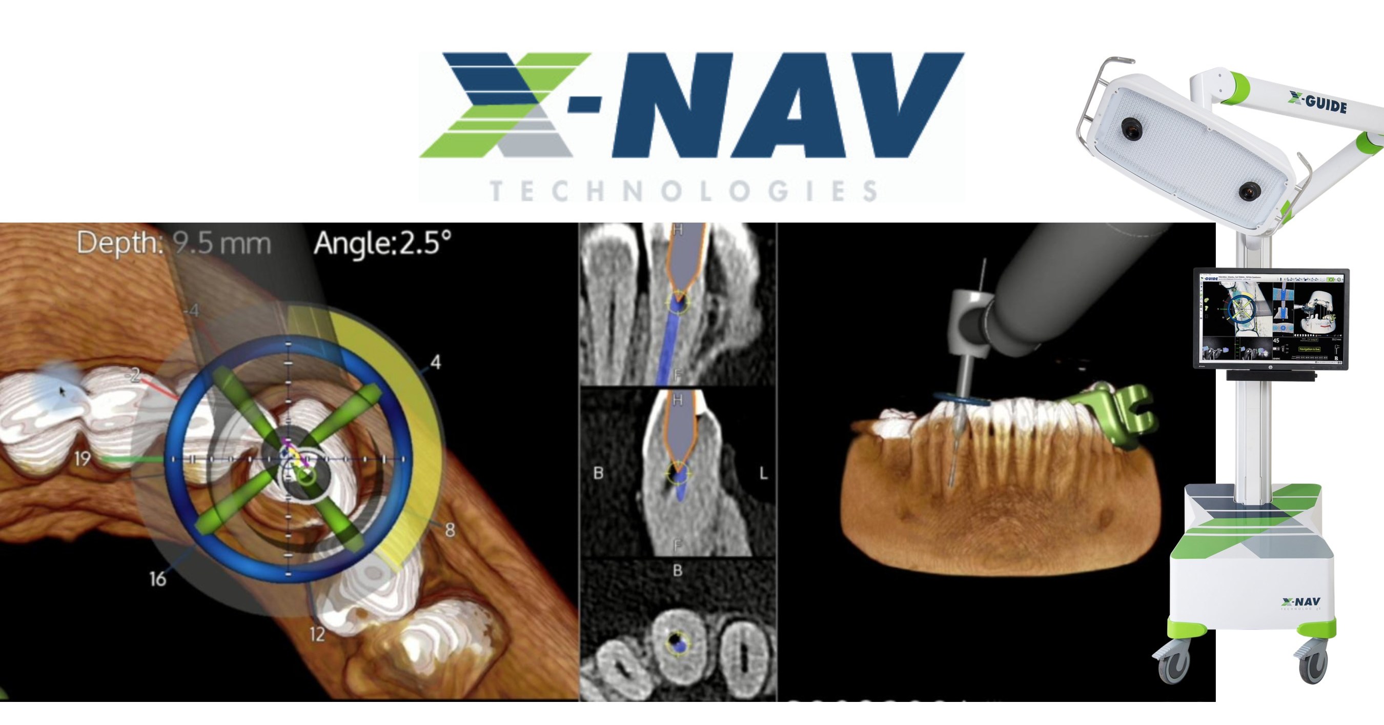 X Guide Dynamic Navigation Receives Fda 510k Clearance To Aid In Minimally Invasive Endodontic 