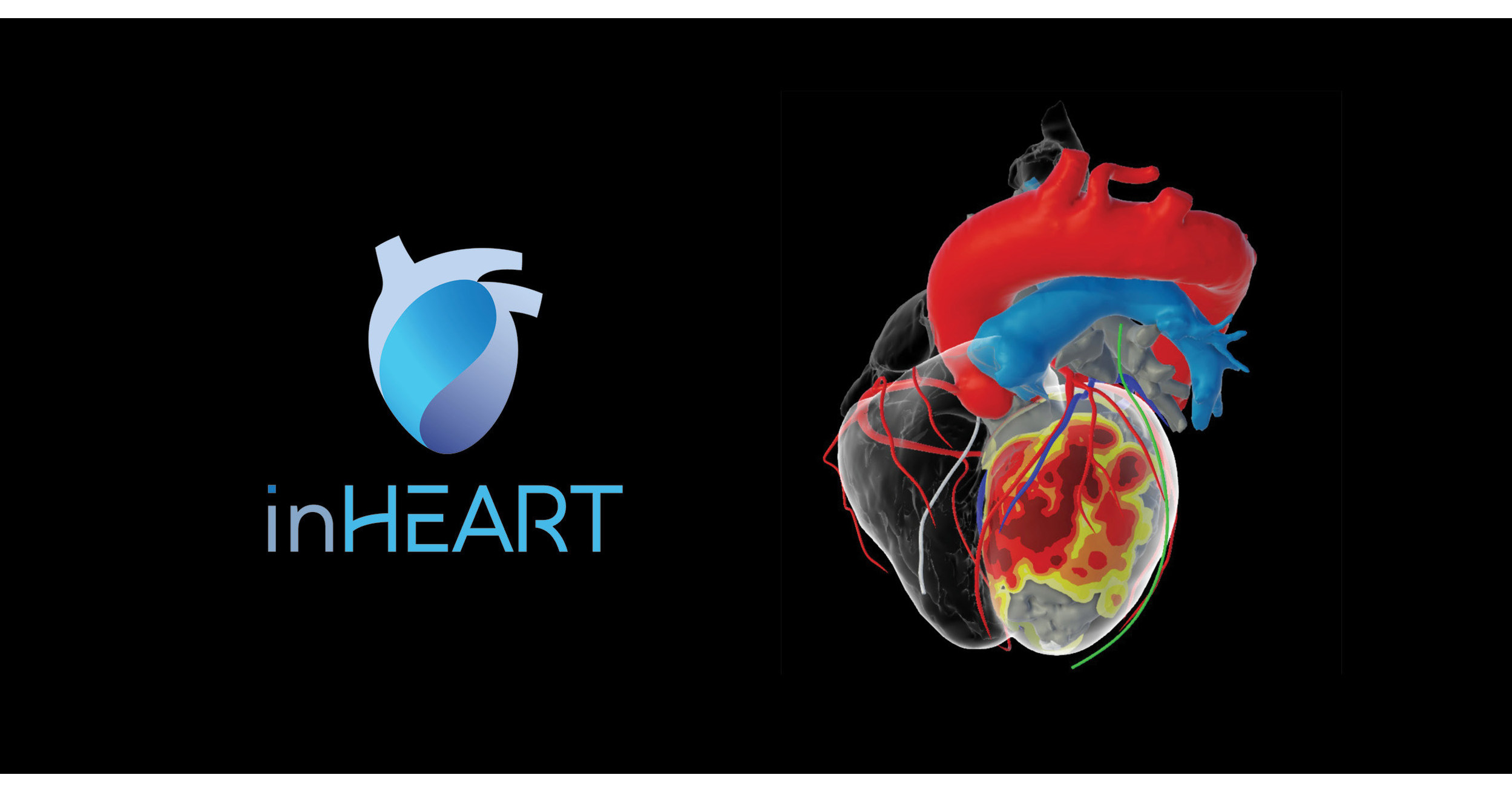 inHEART RECEIVES FDA CLEARANCE FOR NOVEL 3D CARDIAC MODELING SOLUTION