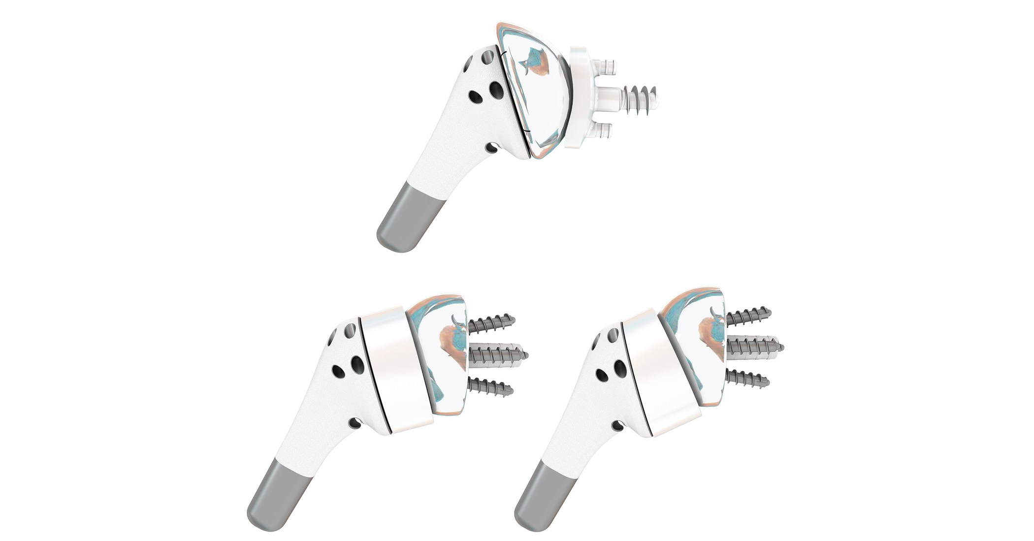 FX Receives 510k Clearance for FX V135® Shoulder Arthroplasty Platform