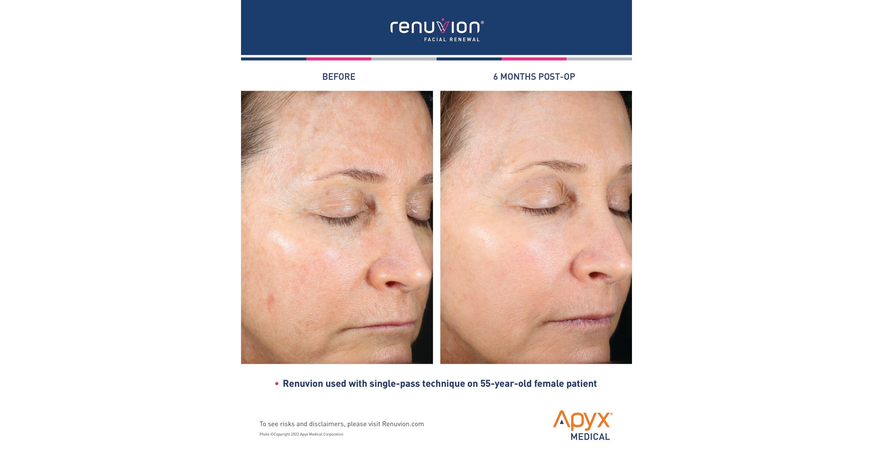 RENUVION® DERMAL HANDPIECE FOR WRINKLE-REDUCTION PROCEDURES CLEARED BY FDA