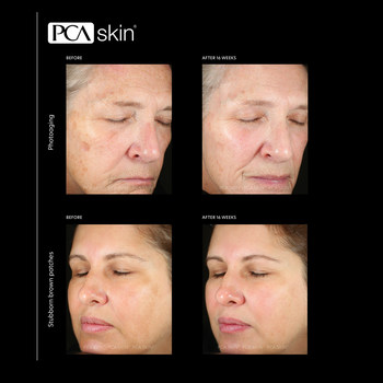 Get Even with Uneven Skin, PCA SKIN® Introduces New Pigment Gel® Pro