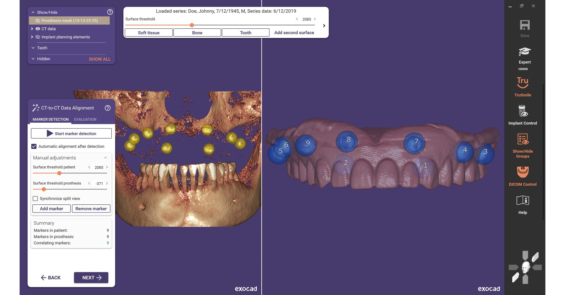 EXOCAD RELEASES EXOPLAN 3.0 GALWAY SOFTWARE IN THE UNITED STATES