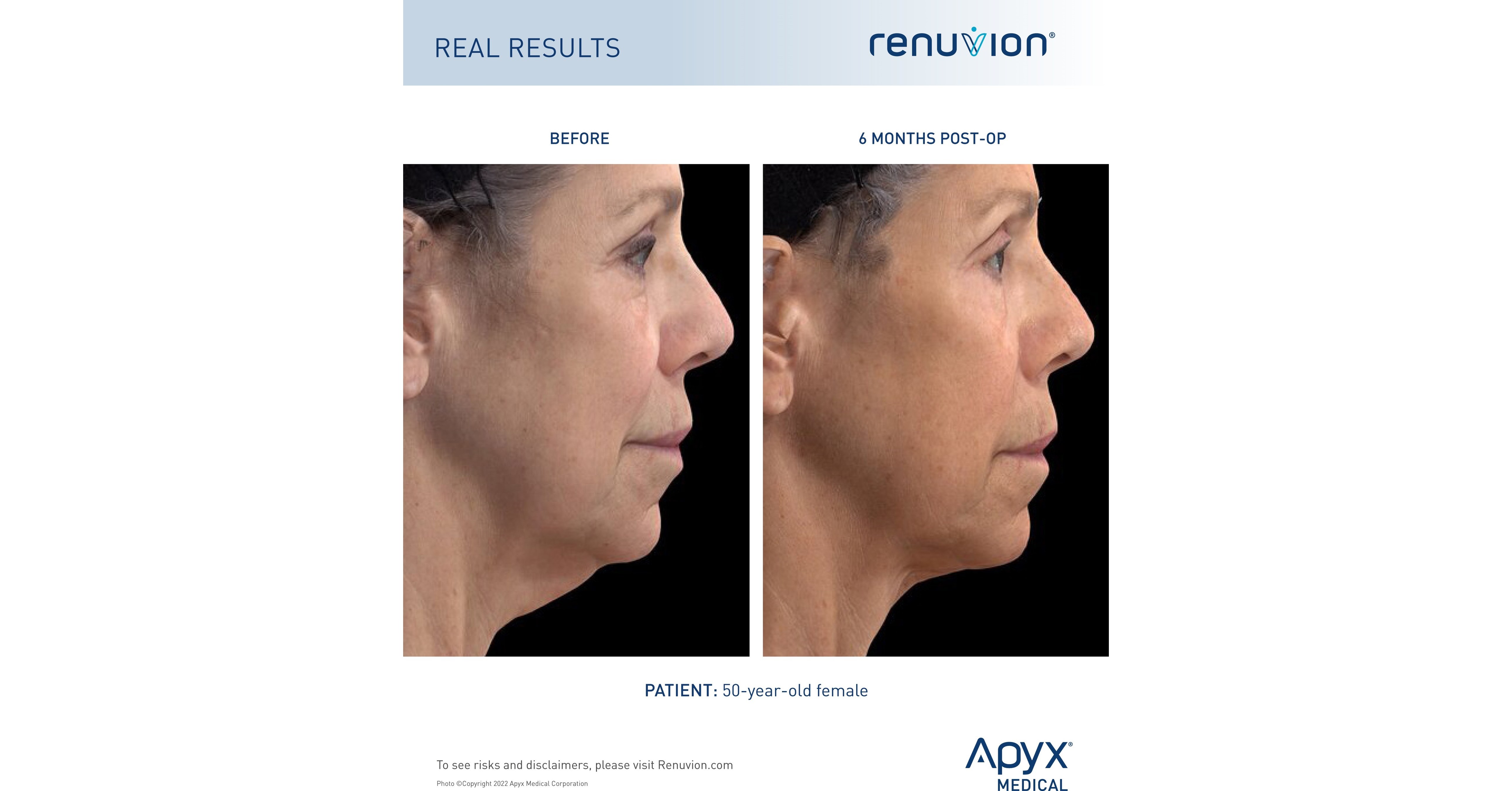 RENUVION® CLEARED BY FDA FOR NECK LAXITY PROCEDURES OFFERING PATIENTS A ...