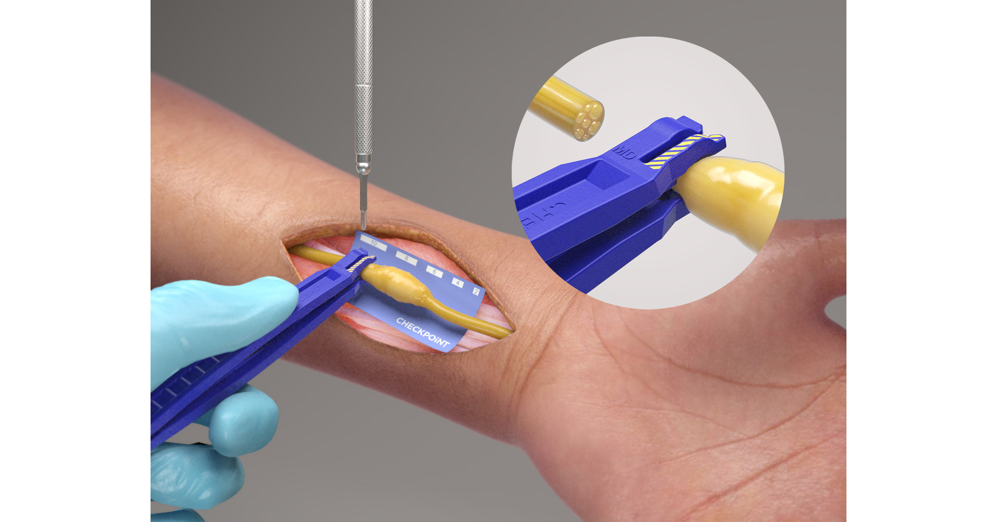 Checkpoint Surgical launches Checkpoint Edge™ Nerve Cutting Kit ...