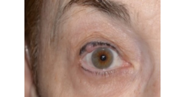 Is that Just a "Lump or Bump" on Your Eyelid or Is It a Cancerous ...