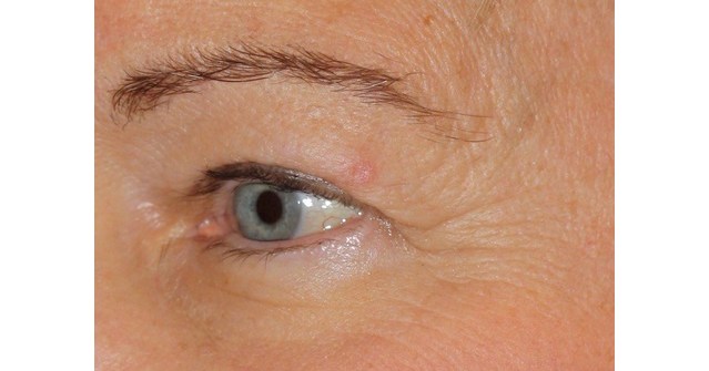 Is that Just a "Lump or Bump" on Your Eyelid or Is It a Cancerous ...