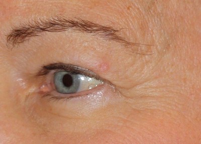 Is that Just a "Lump or Bump" on Your Eyelid or Is It a Cancerous ...