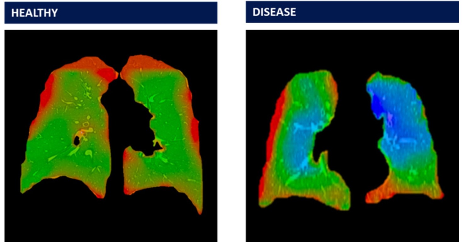Vanderbilt Completes Study Evaluating Advanced, Four-Dimensional Lung ...