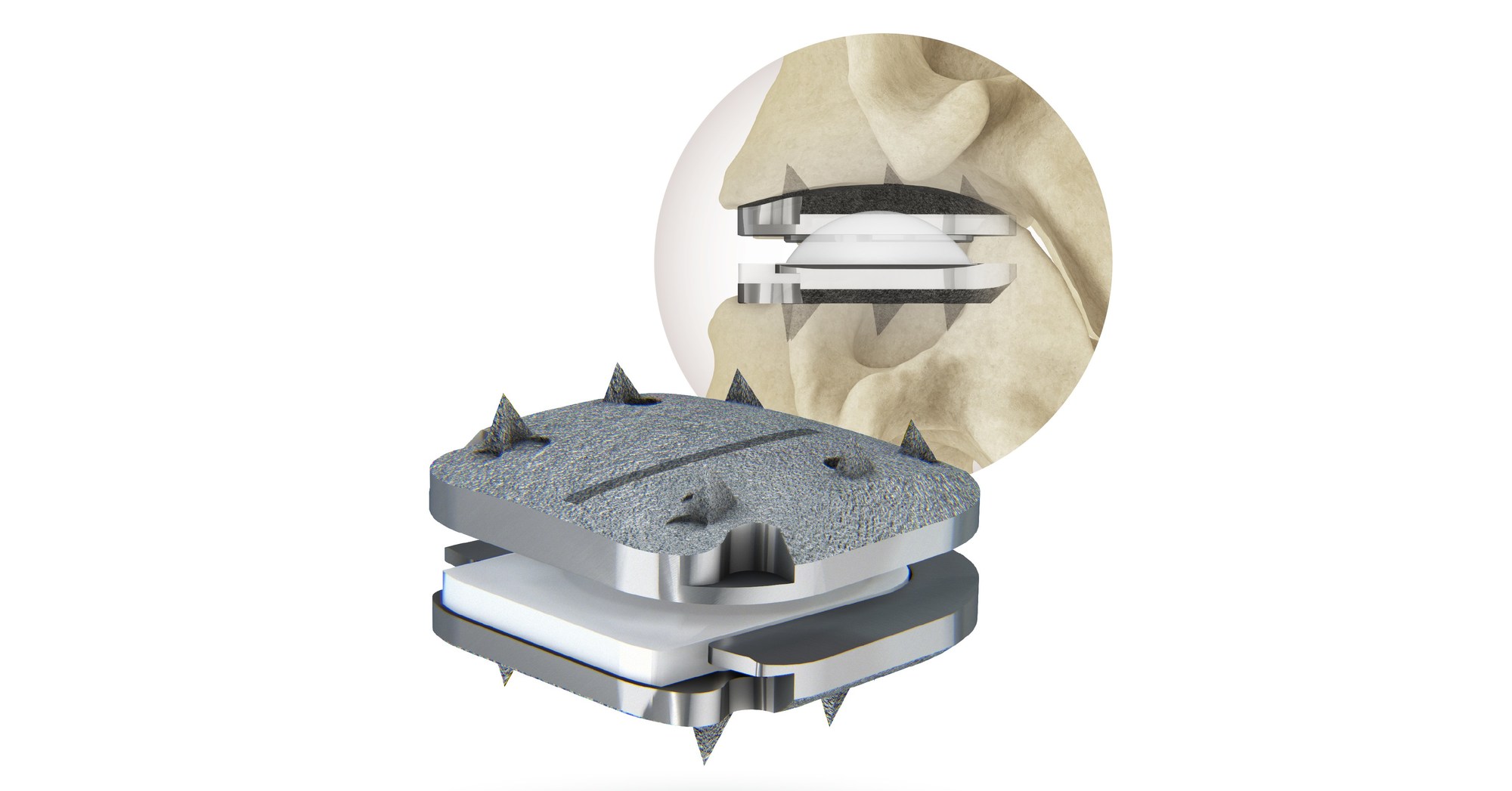 Centinel Spine® Announces First Commercial Use of the prodisc® C Vivo ...