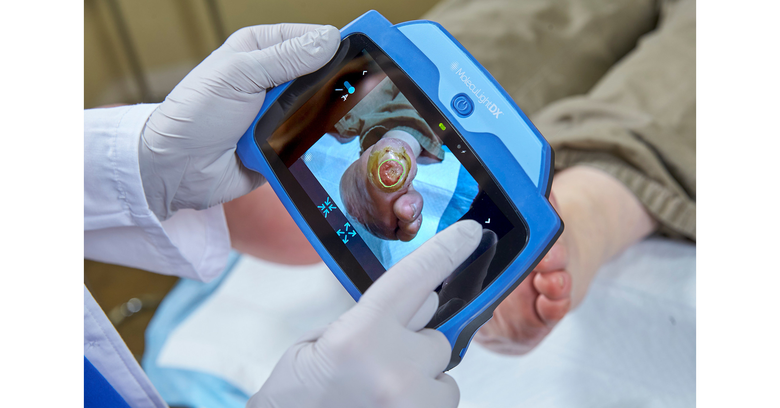 MolecuLight Point-of-Care Wound Imaging Devices Awarded Group ...