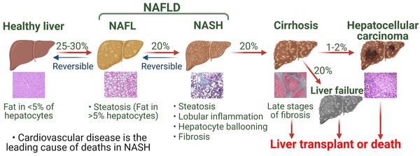 Pathogenesis of Non-alcoholic Fatty Liver Disease: Chinese Medical ...