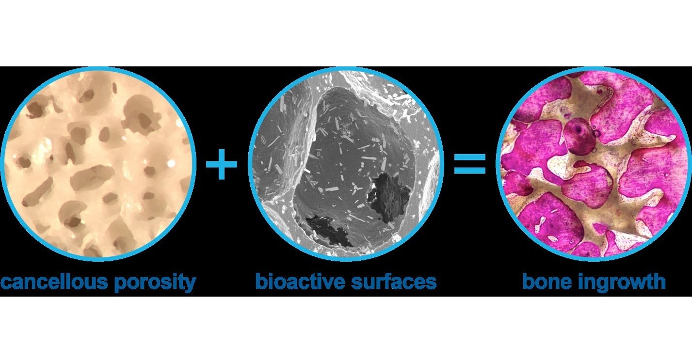 cultivate(MD) Capital Funds Announces HAPPE Spine's Additional Patents ...