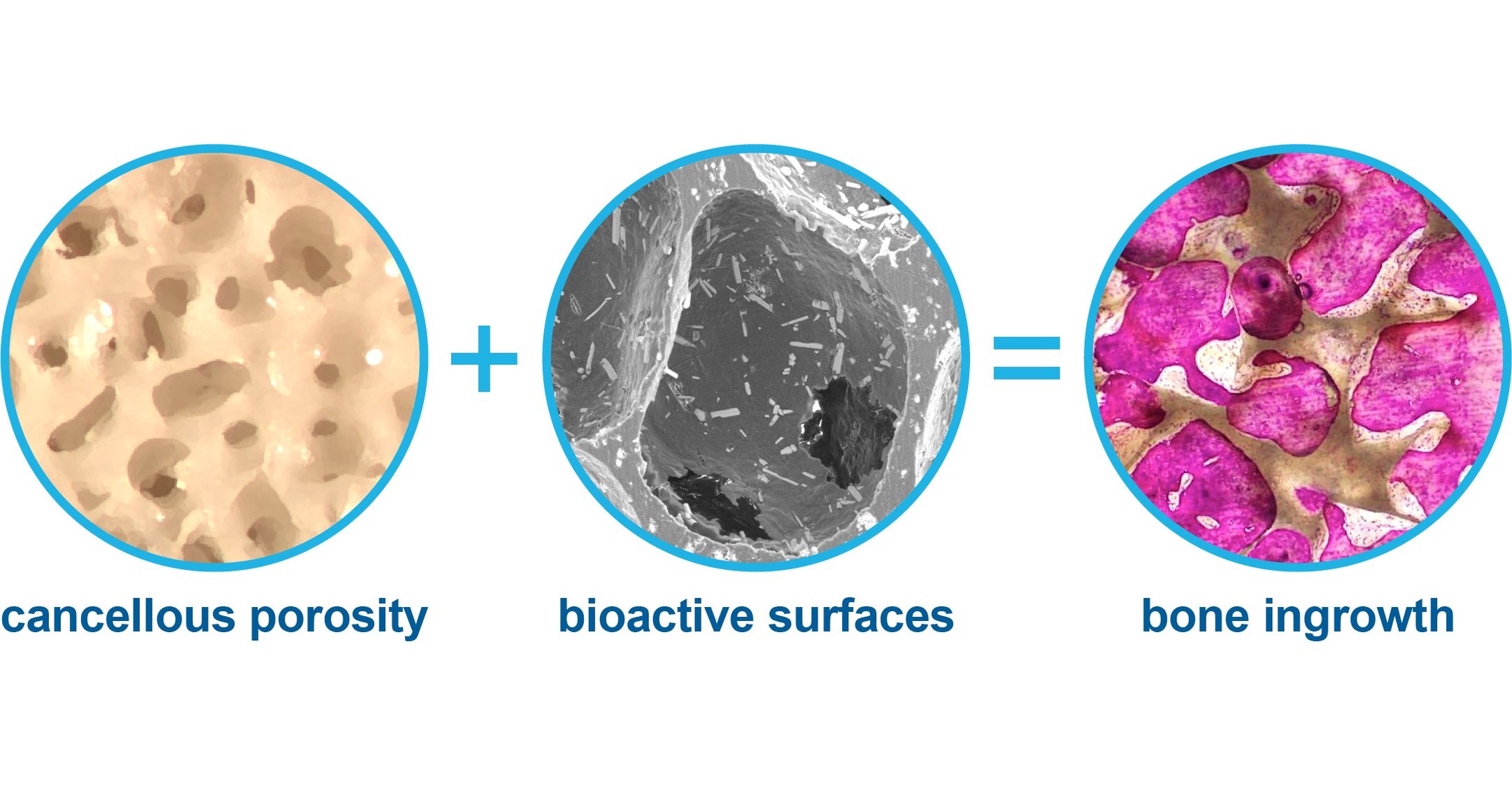 HAPPE SPINE ANNOUNCES ADDITIONAL PATENTS FOR HYDROXYAPATITE POROUS ...