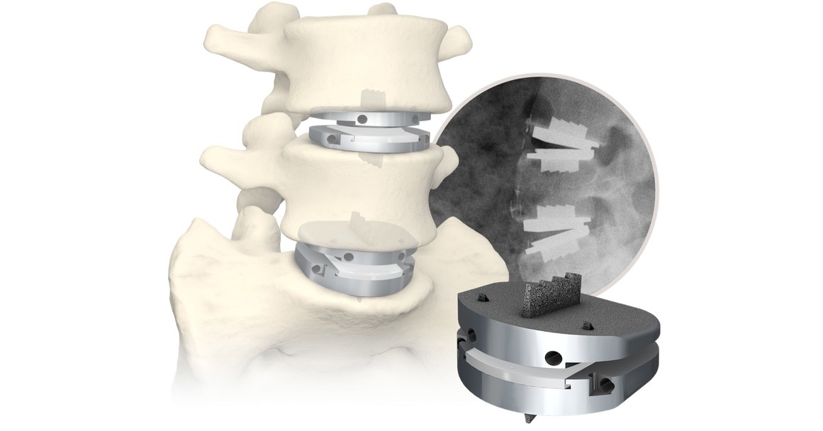 Study Featured at NASS 2022 Demonstrates Long-Term Effectiveness of ...