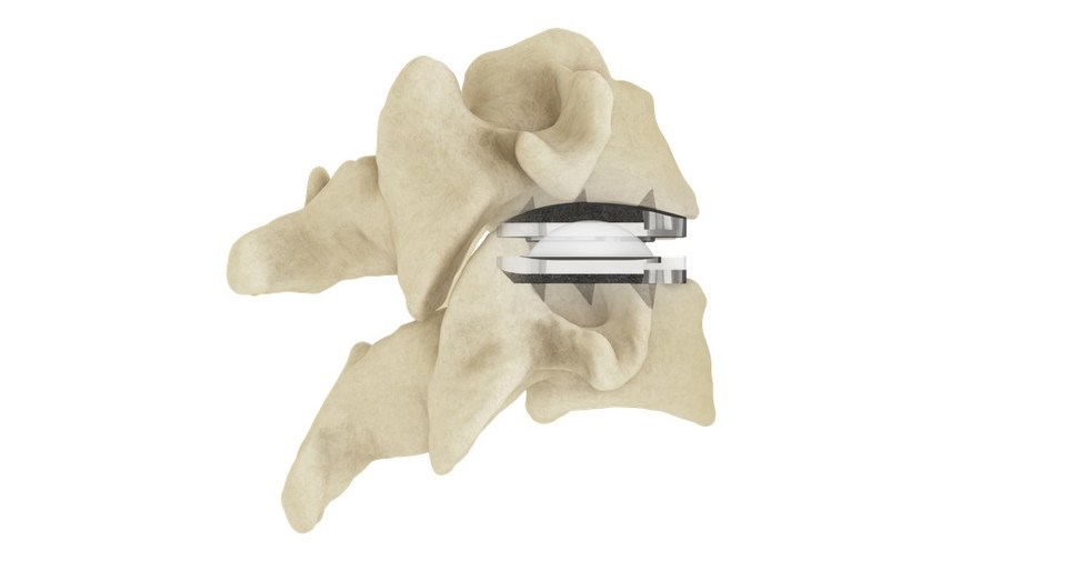 Centinel Spine Announces 100th Procedure with prodisc® C Vivo Cervical ...