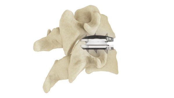 Centinel Spine Announces 100th Procedure with prodisc® C Vivo Cervical ...