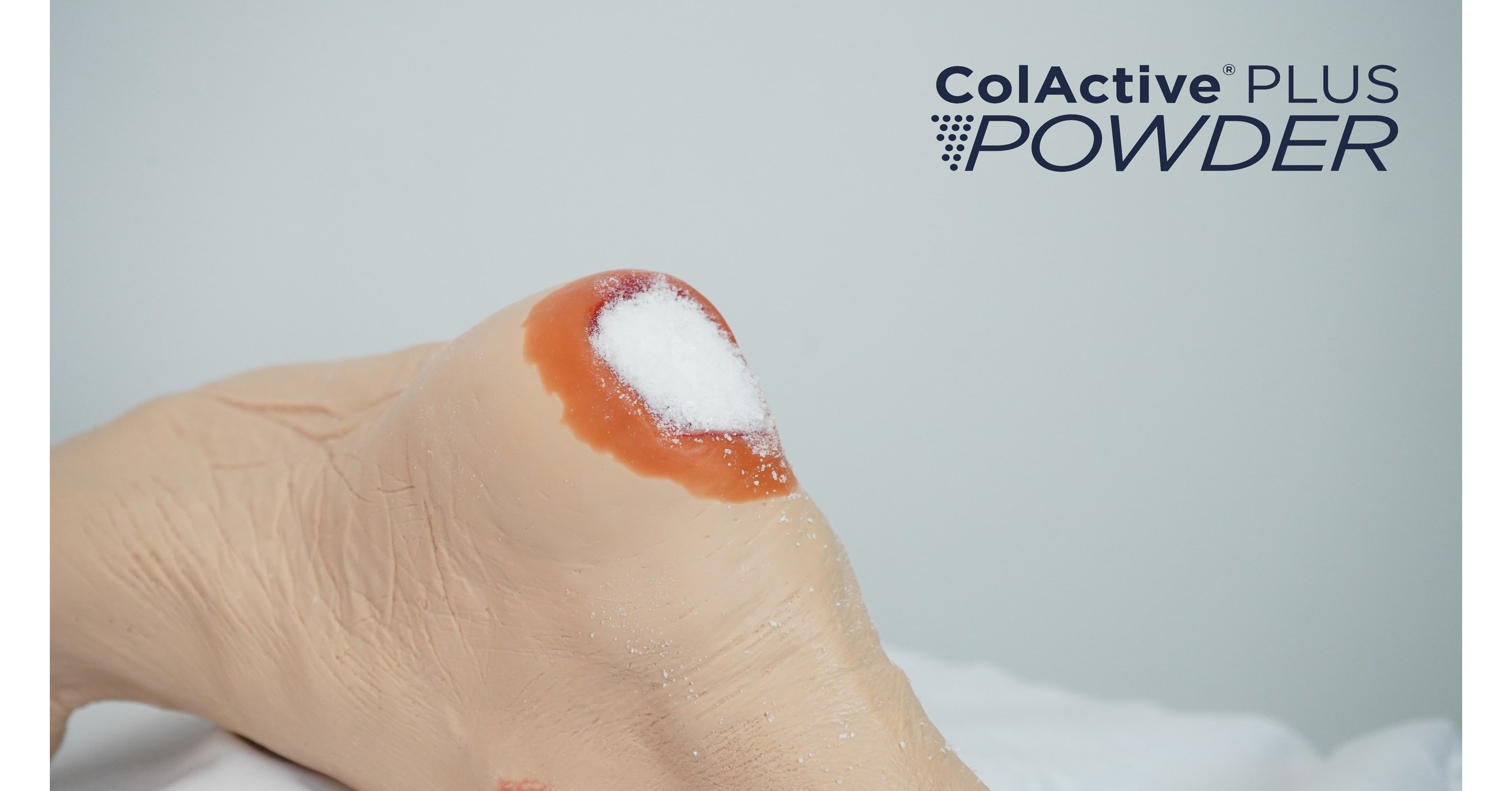 Closing Chronic Wounds with Collagen Powder: University of Michigan ...