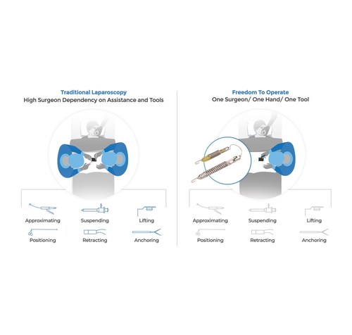 Virtual- Ports Introduces a New One Hand, One Tool Laparoscopy ...