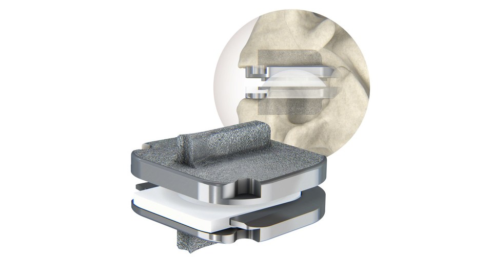 Centinel Spine® Announces First Commercial Use of prodisc® C SK ...