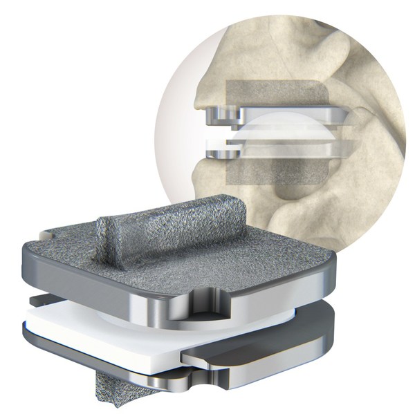 Centinel Spine® Announces First Commercial Use of prodisc® C SK ...