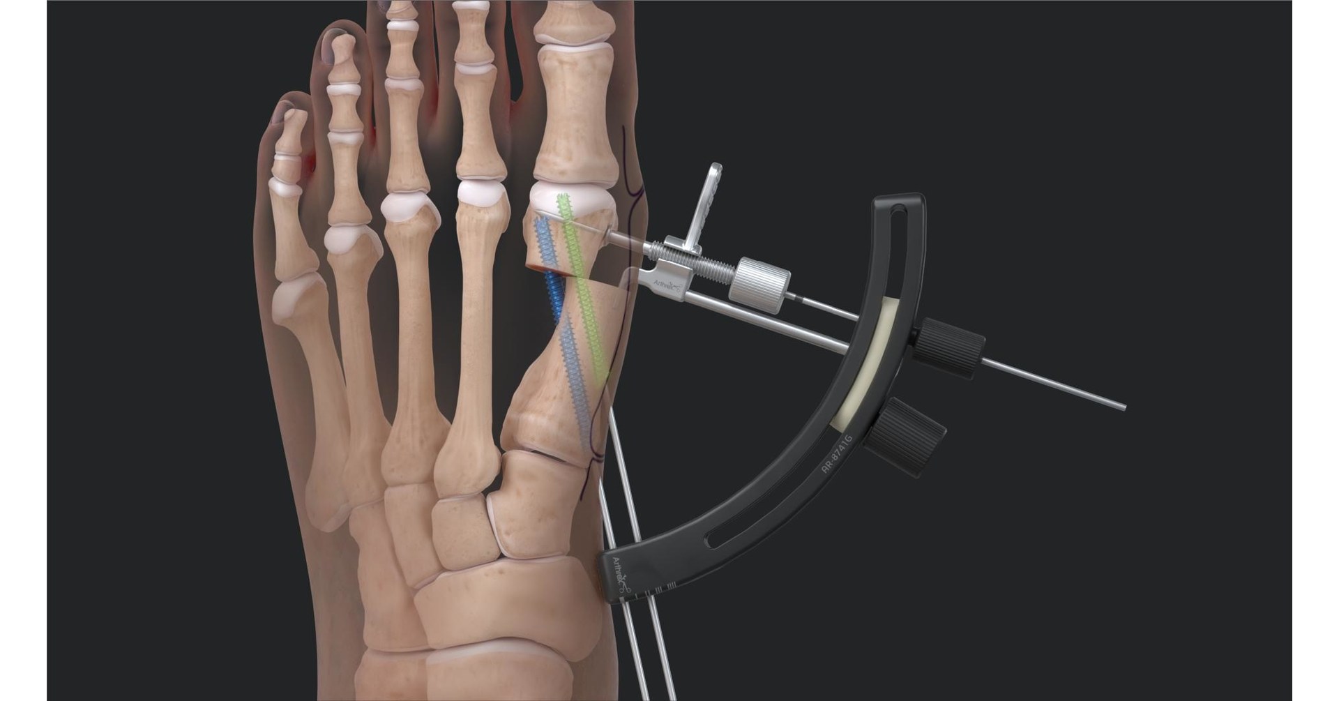 Arthrex Innovates Bunion Correction With Minimally Invasive Procedure