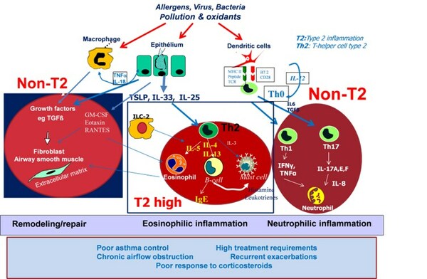 Chinese Medical Journal Review Offers Valuable Insights into Severe Asthma