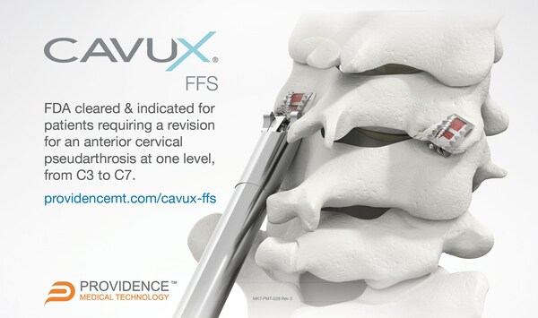 Providence Medical Technology announces FDA Clearance of the CAVUX ...