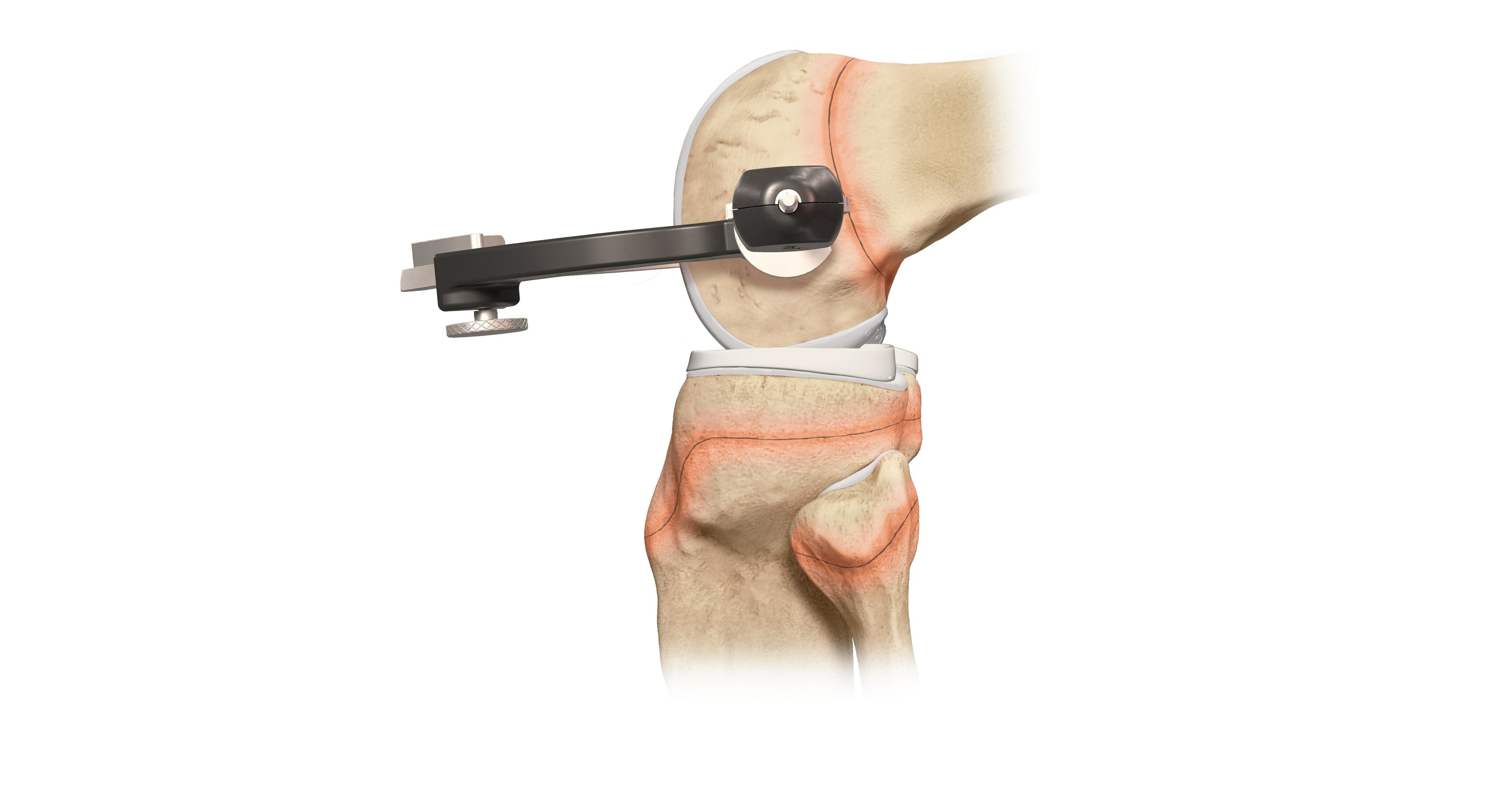 Arthrex Receives FDA Clearance for TightRope® Implant as First, Only ...