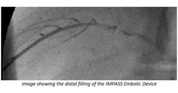 Fluidx Unveils New Embolic for Neurovascular Use
