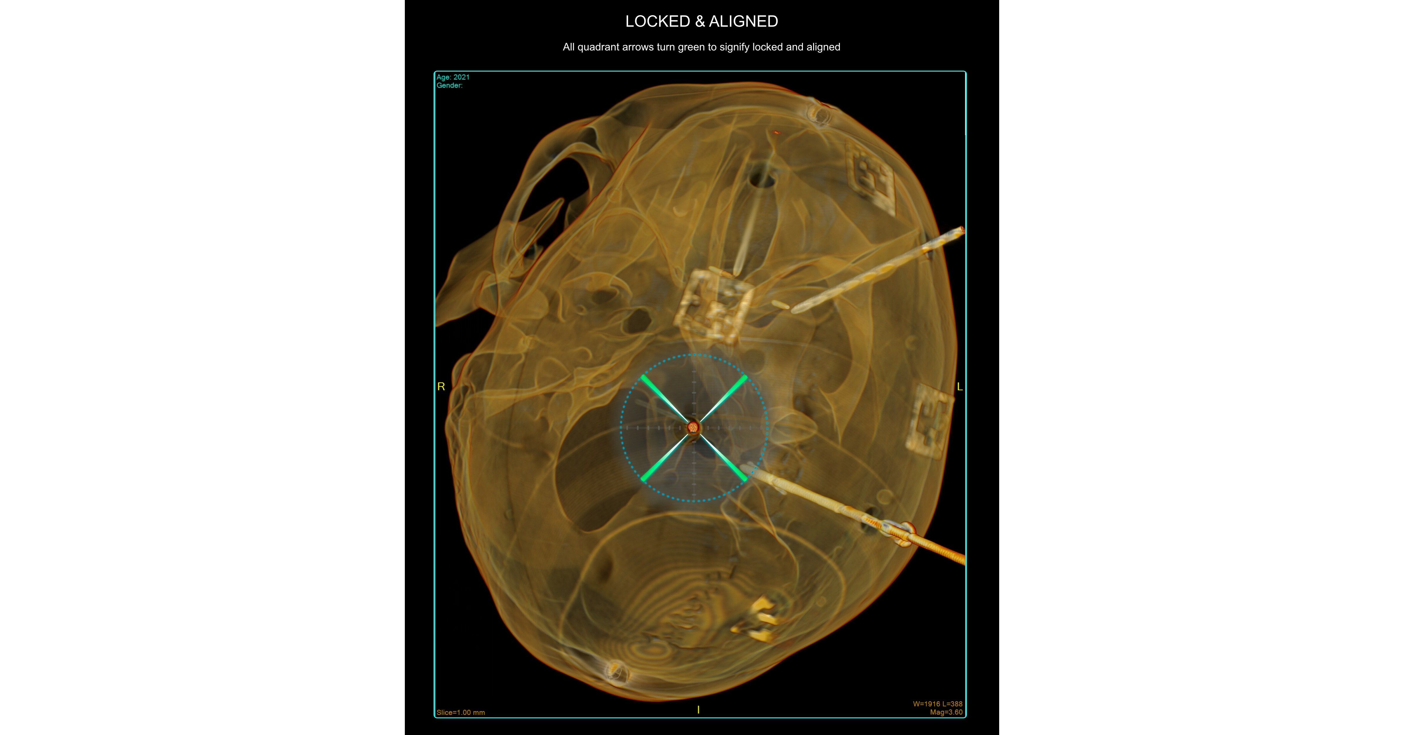 Novarad's VisAR System Demonstrates High Accuracy for EVD Placement