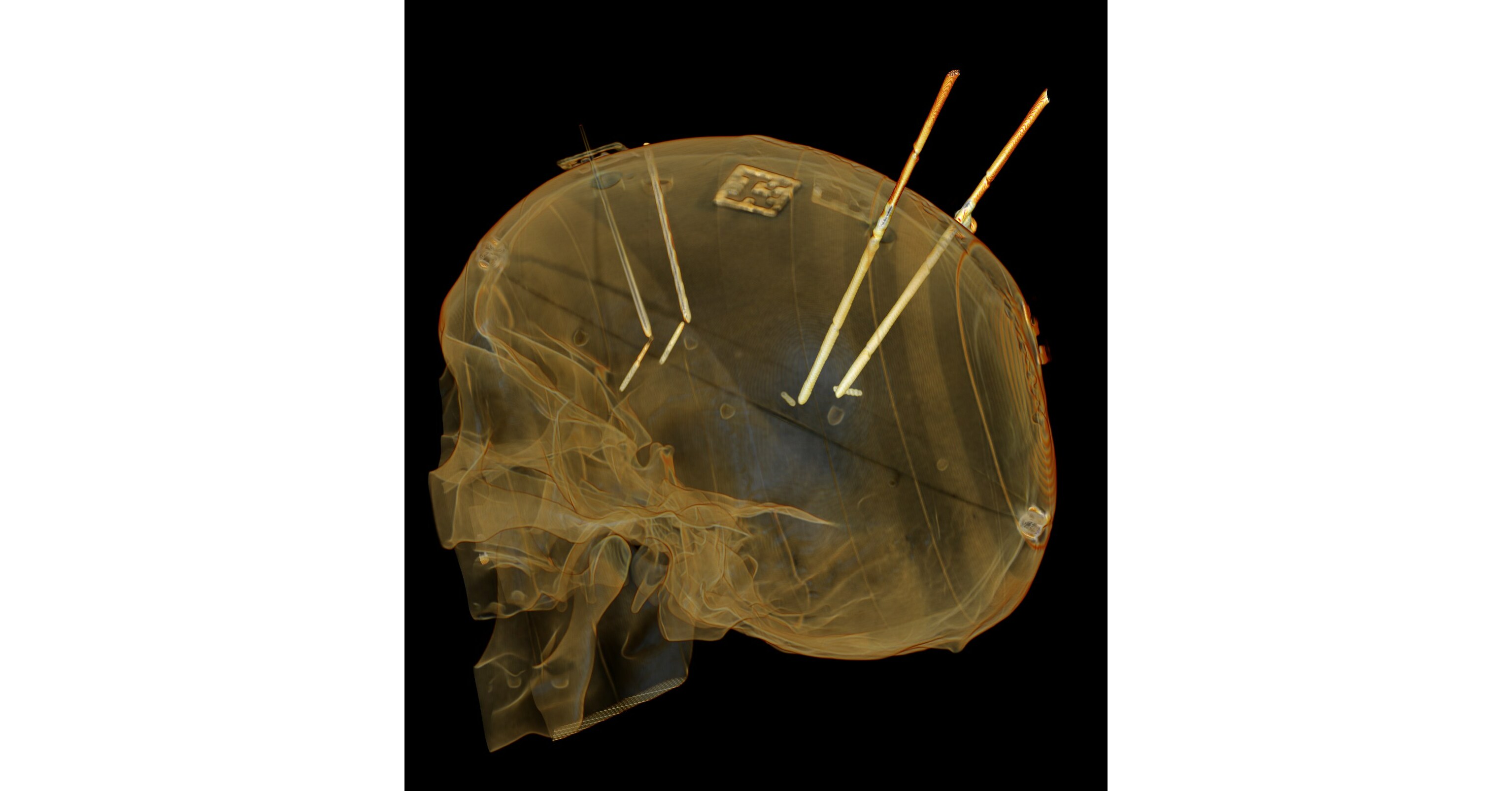 Novarad's VisAR System Demonstrates High Accuracy for EVD Placement