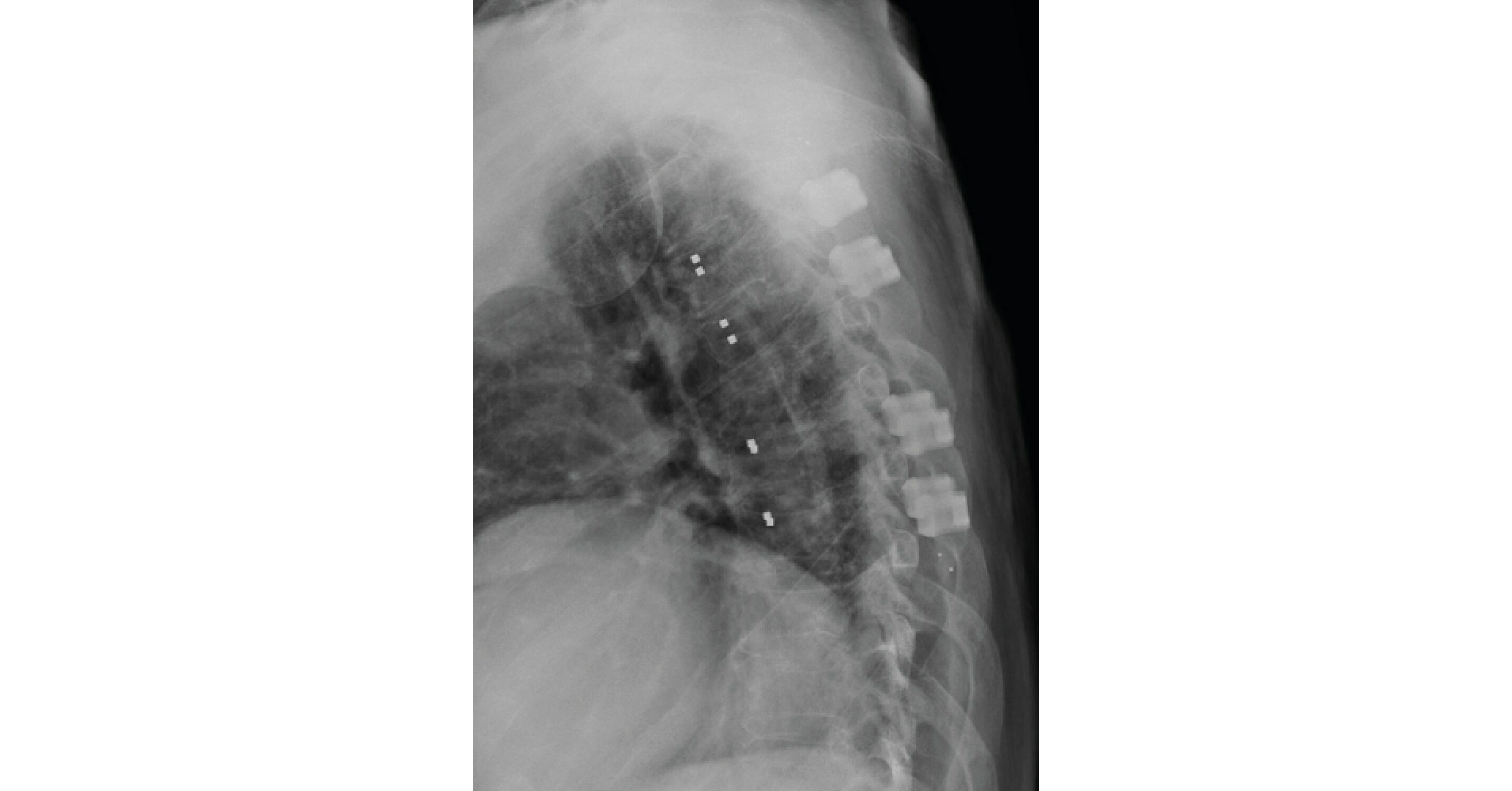 icotec ag Receives FDA Clearance for the Ø 4.5mm VADER® Pedicle Screws