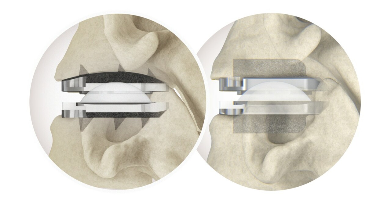 Centinel Spine® Announces 500th Procedure with prodisc® C Vivo and ...