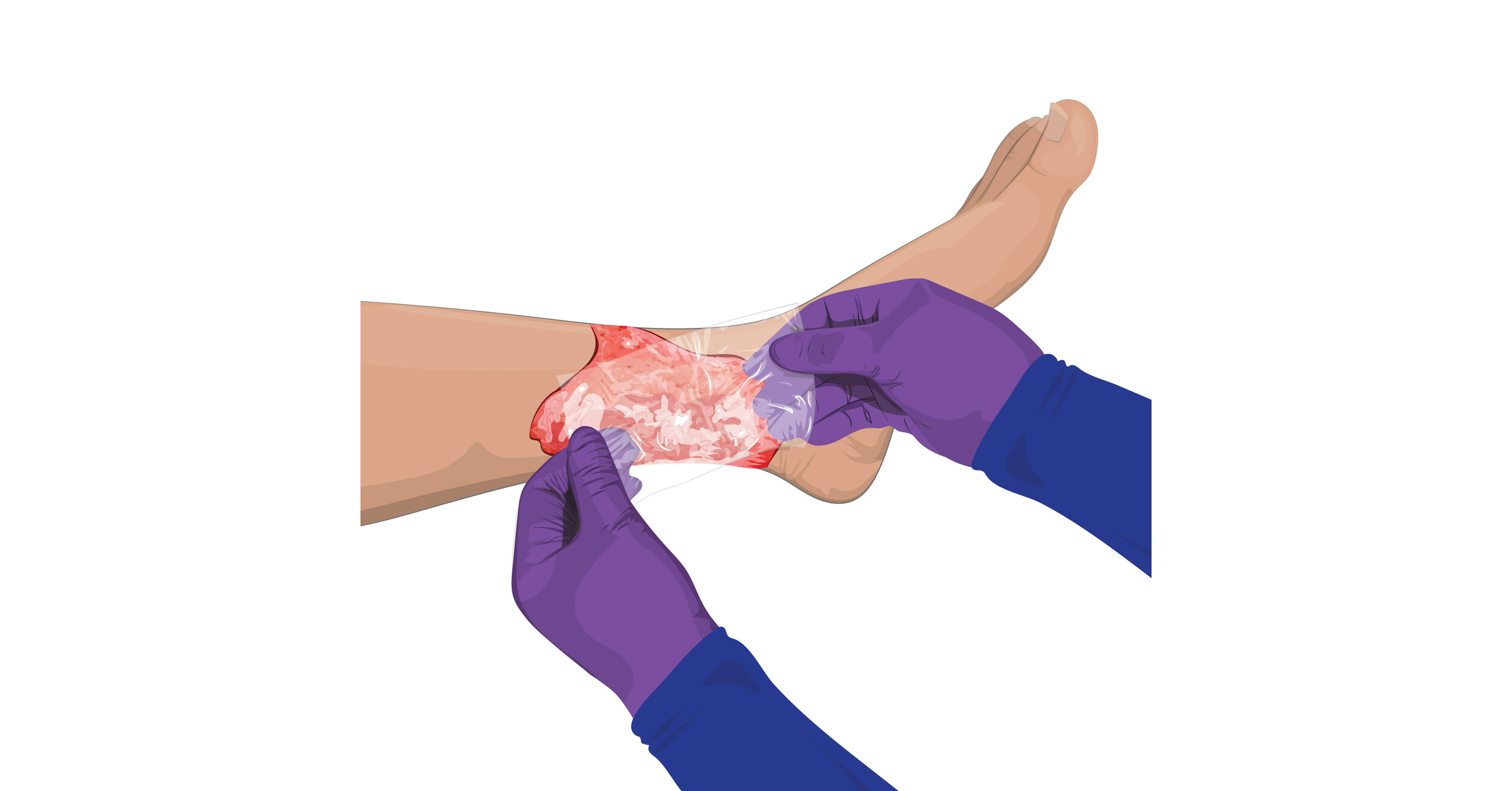 FDA clears first placental extracellular matrix medical device for ...