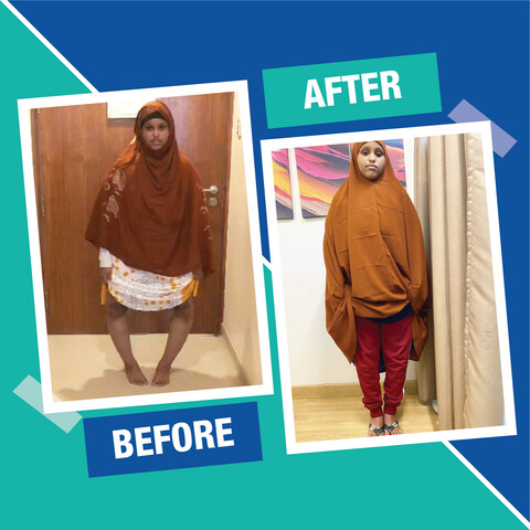 From Deformity To Mobility 16 Year Old Girl s Life Transformed With From Deformity To Mobility 16 Year Old Girl s Life Transformed With