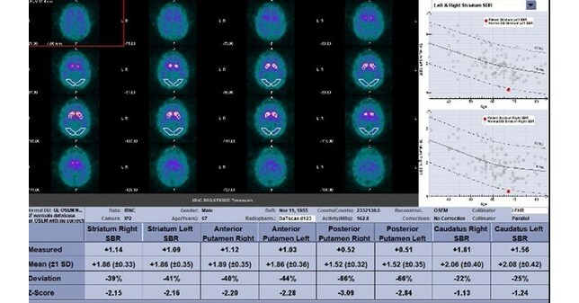 SimonMed Announces Offering of DaTscan