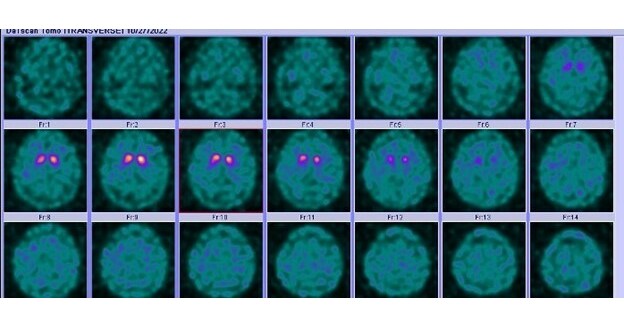 SimonMed Announces Offering of DaTscan