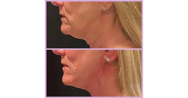 PDO Max® Launches PDO MAX DUO™ PDO Threads: Advanced Precision for ...